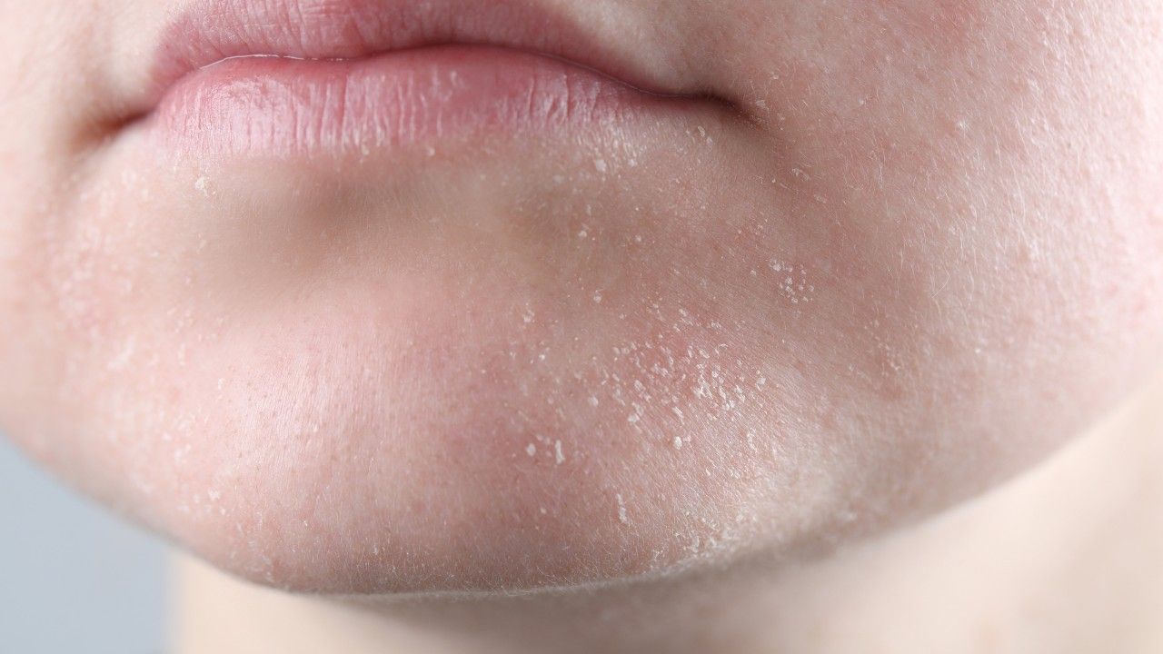 White Patches On Baby Skin: Causes & Treatment